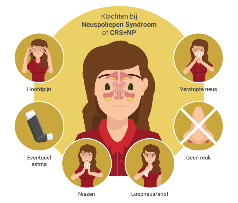 Wat is Neuspoliepen Syndroom of CRSwNP? | Neuspoliepen Syndroom ...